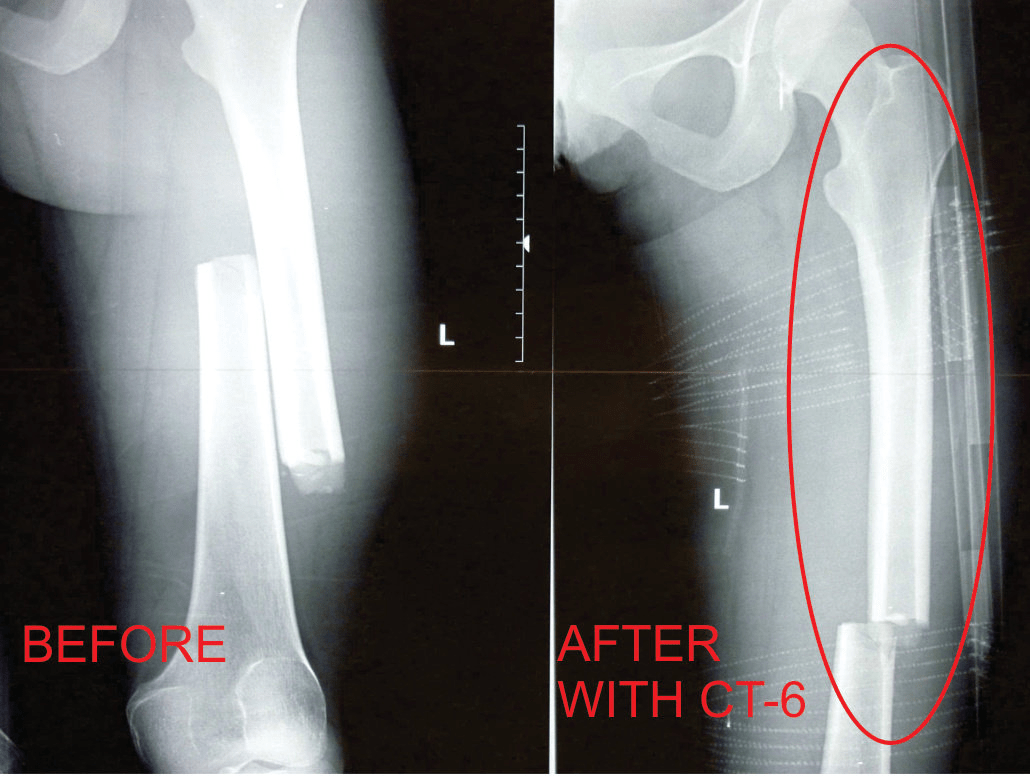 Splint, CT-7 Leg Traction Splint — CTOMS